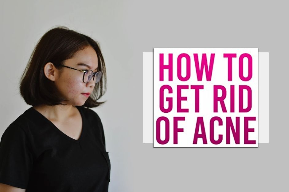 Easy Ways to Treat Your Stubborn Acne at Home : Acne Treatment