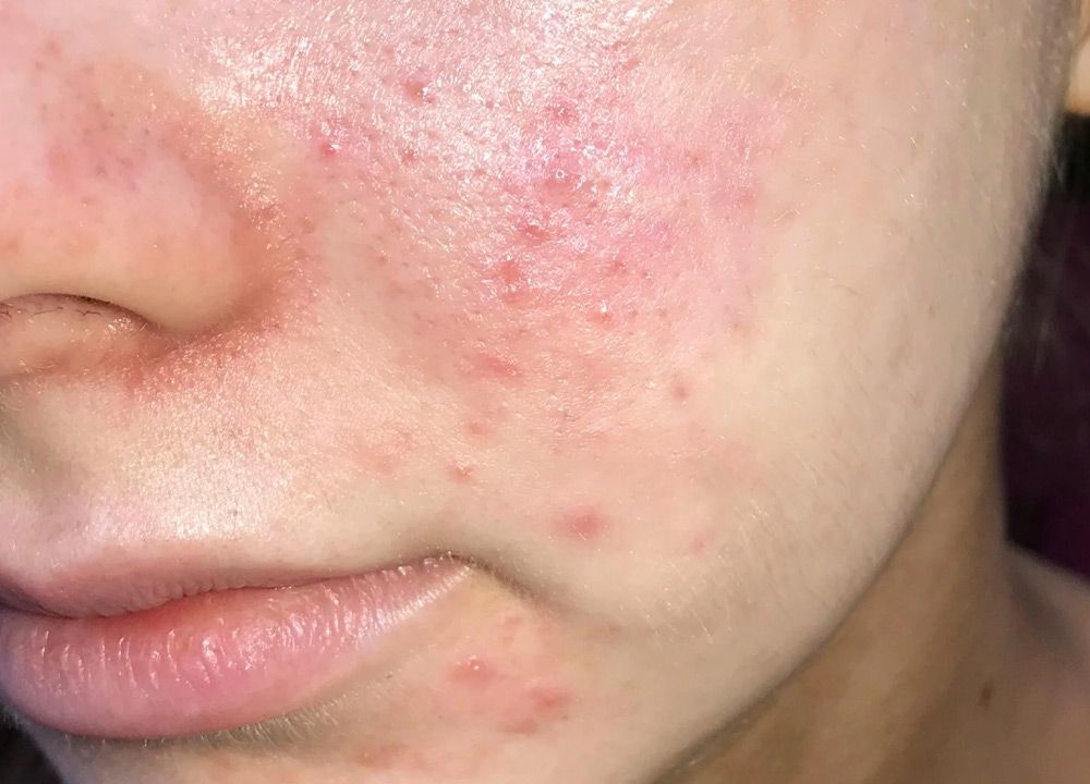 An Overview of Fungal Acne: Causes, Symptoms, and More
