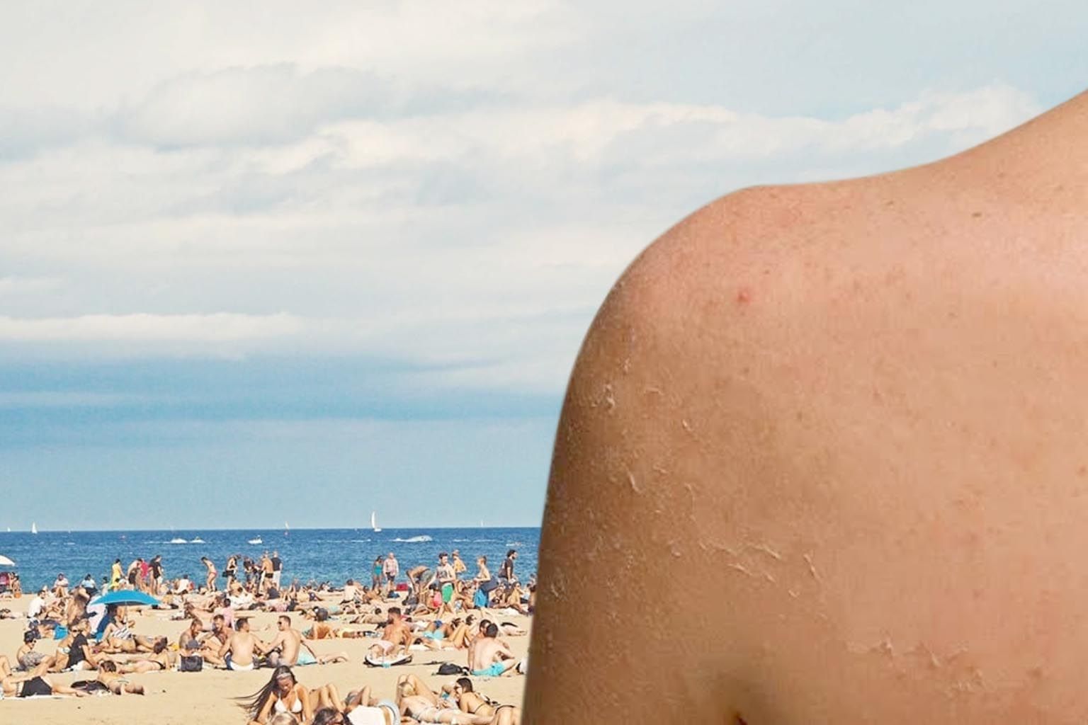 Sunburn: Treatment and Prevention