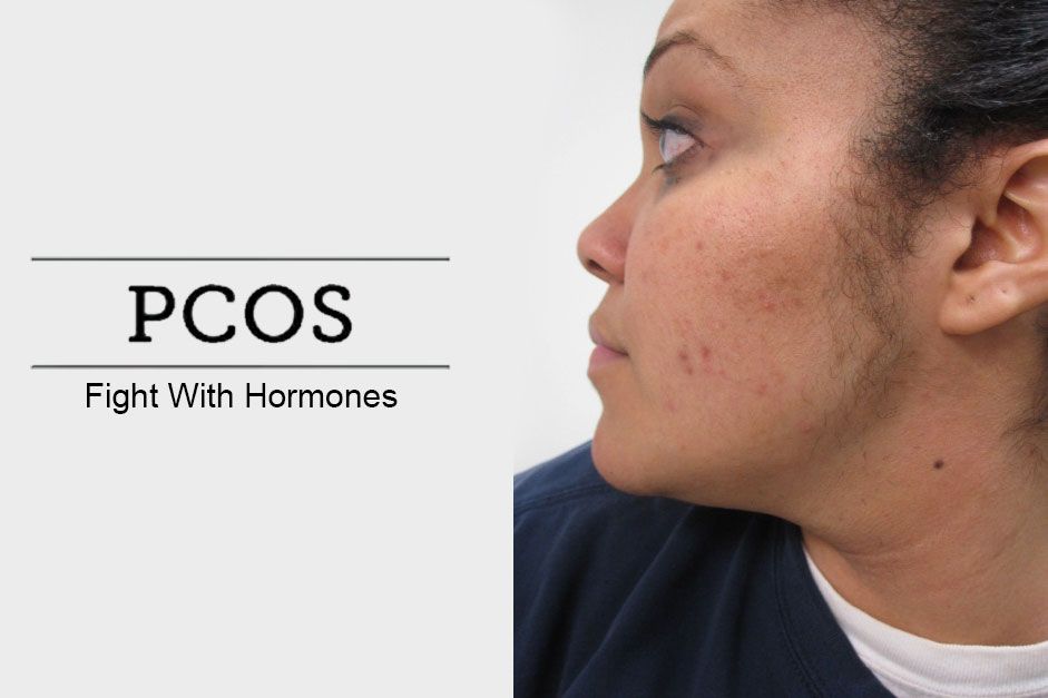 Fight With Hormones: Everything You Need To Know About PCOS
