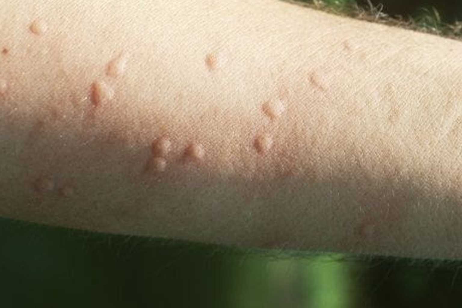 Here is the Solution for Your Skin Problem